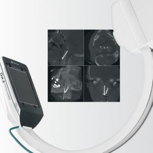 Ziehm Vision RFD 3D Mobile C-arm for surgical x-ray imaging