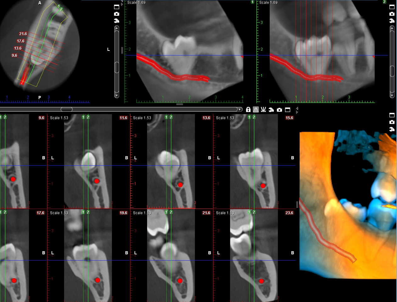Promax 3D Mid, Cone beam CT, CBCT, 3D Dental X-ray, Planmeca